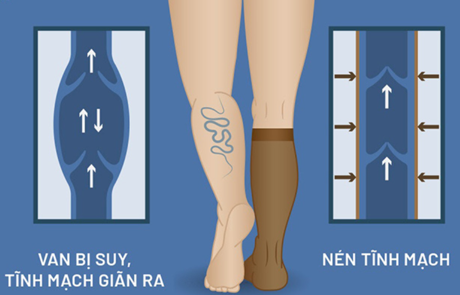 Thông tin hoạt động | Suy Giãn Tĩnh Mạch Chi Dưới Và Phương Pháp Điều Trị